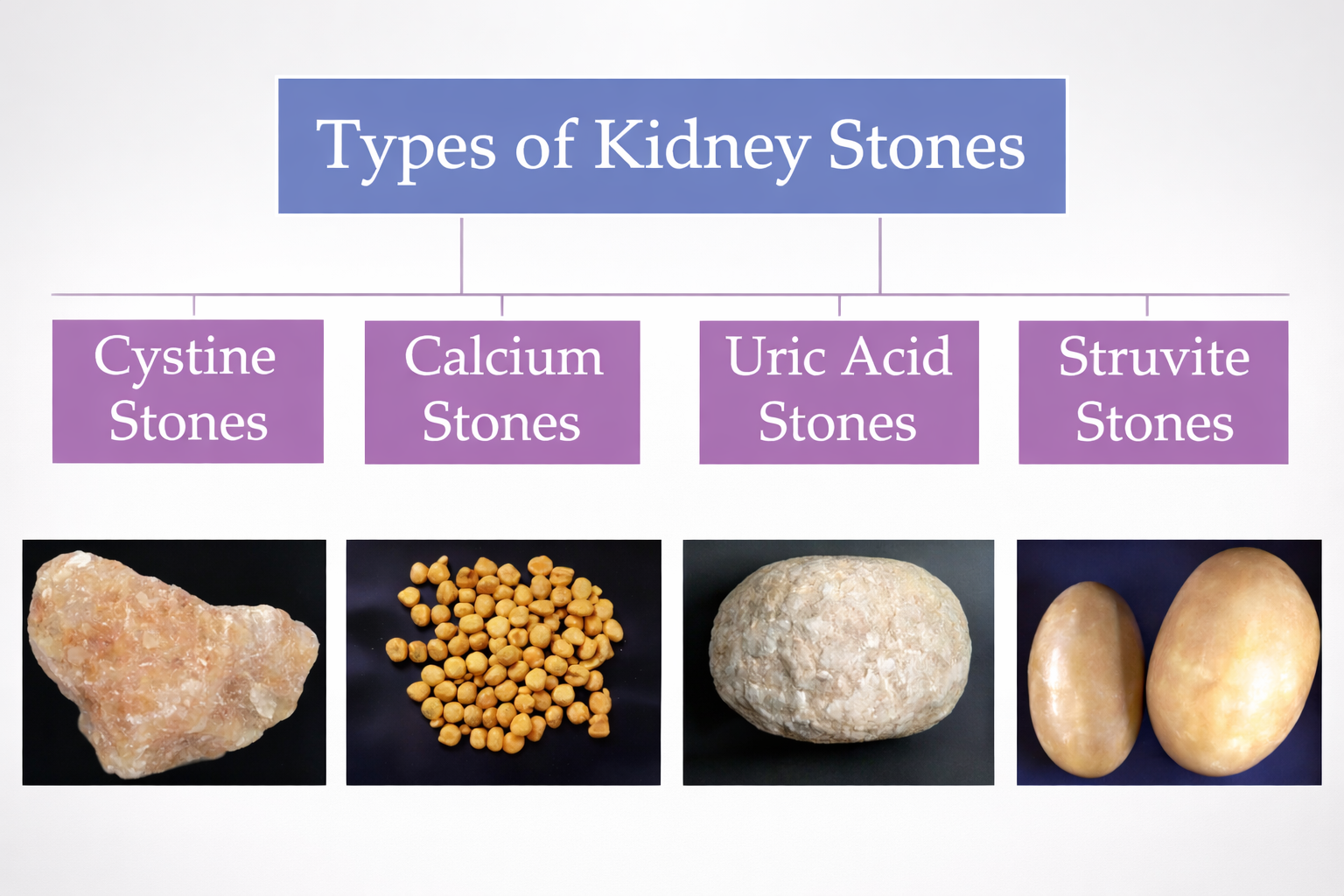 Types of Kidney Stones and How They Form